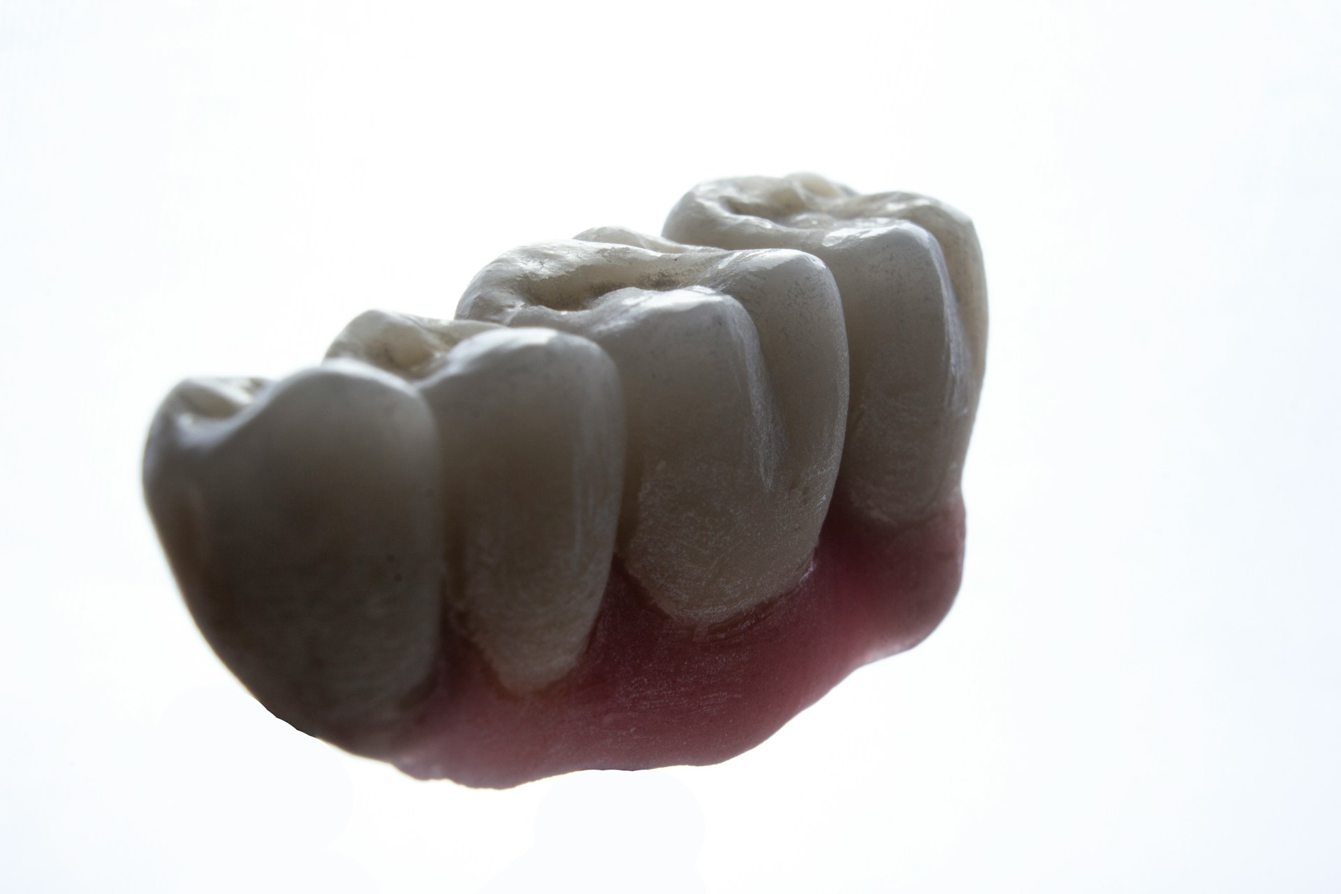 Amalgam vs White Fillings: Why the Debate Is Already Over - UrgentCare ...