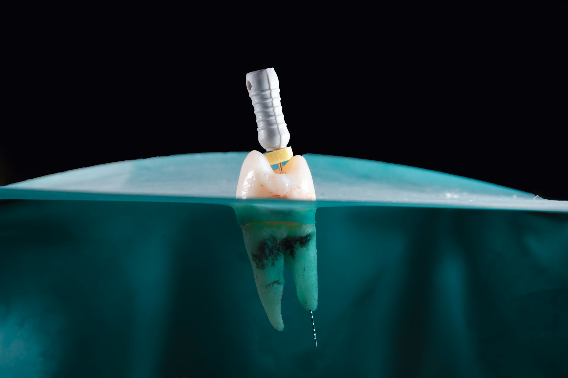 What Is Root Canal Treatment? The Procedure Explained - UrgentCare Dental